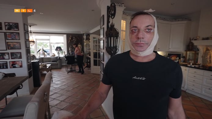 Gerard Joling bont en blauw na gezichtsoperatie: 'Toch niet normaal ...