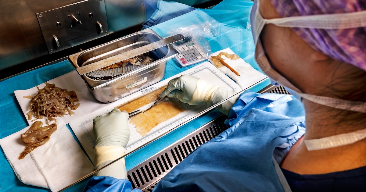 Meters Nederlandse donorhuid helpen Zwitserse slachtoffers cafébrand ...