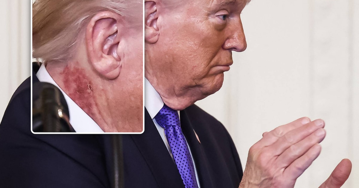 Hoe komt president Trump aan die rode plek in zijn nek? Witte Huis komt ...