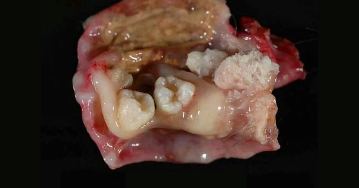 Een tumor met tandjes, plukjes haar en botten: zo ontstaat een teratoom ...